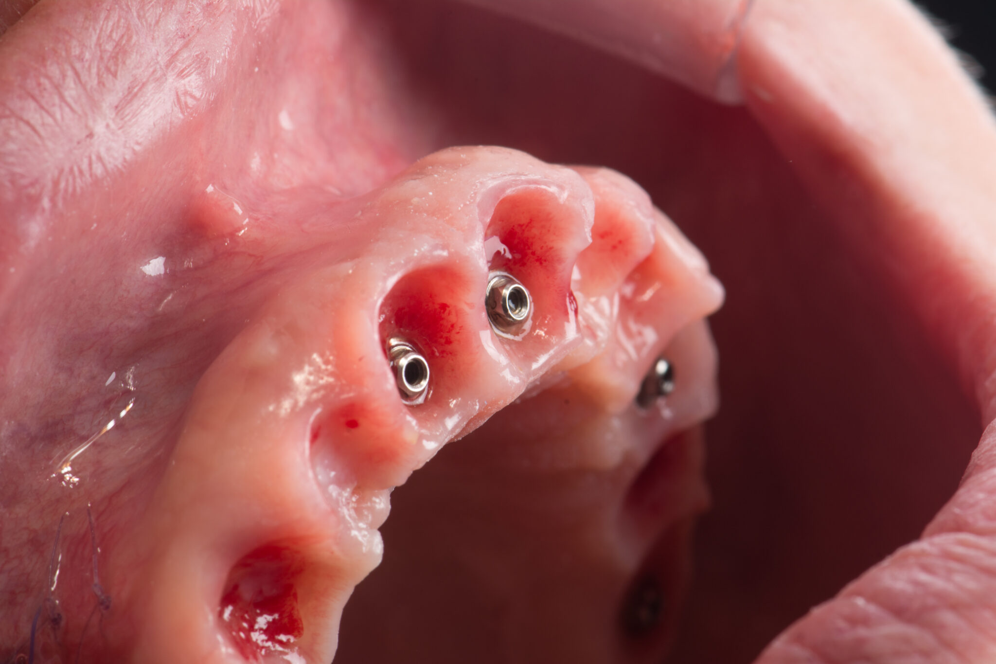PERIO-PROSTHO COURSE: From basics to complex FP1 with Dr Paulo Carvalho ...